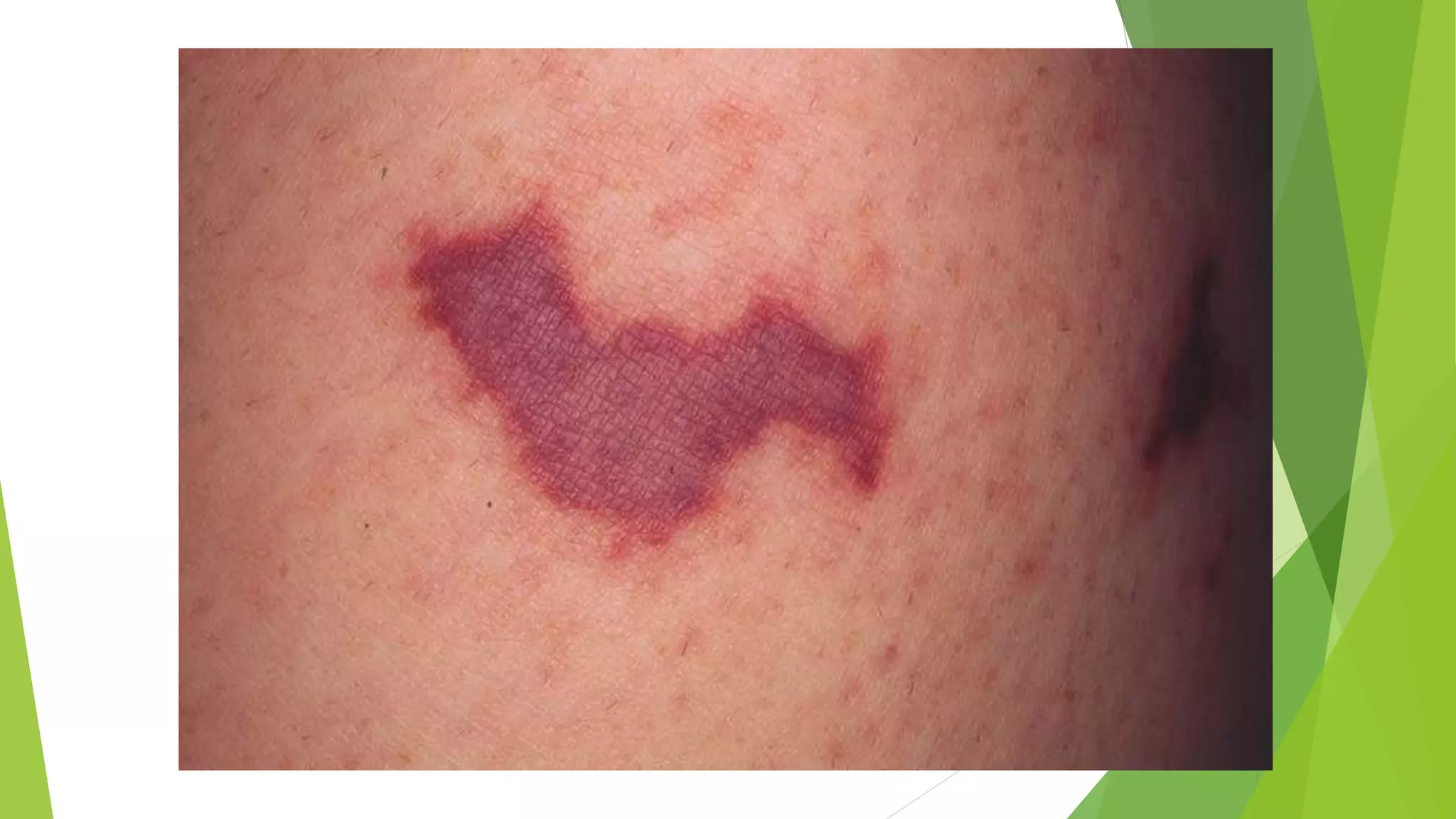 Fever and rash in pediatrics - Dr Ameen Alawadhi | PPTX