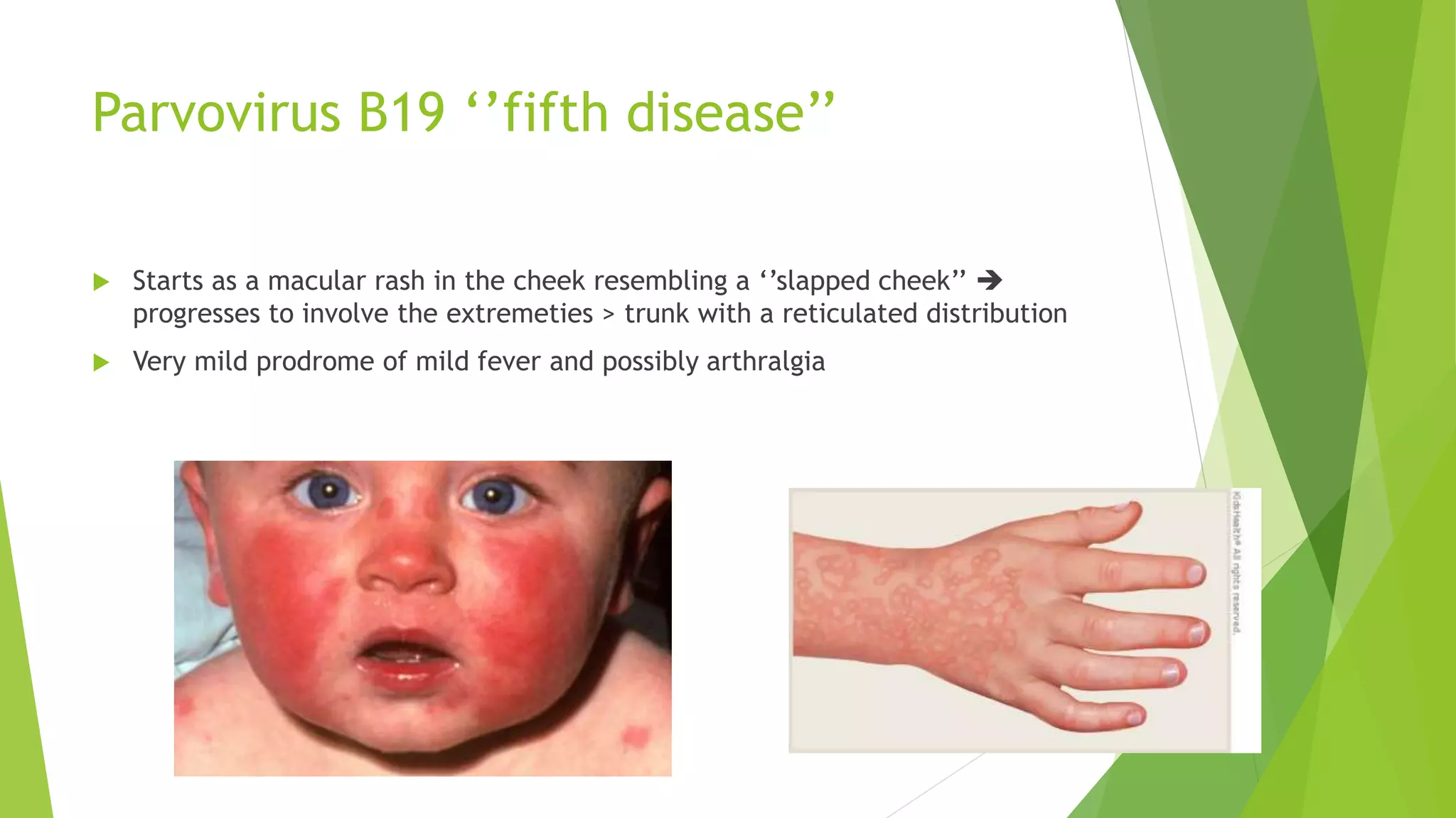 Fever and rash in pediatrics - Dr Ameen Alawadhi | PPTX