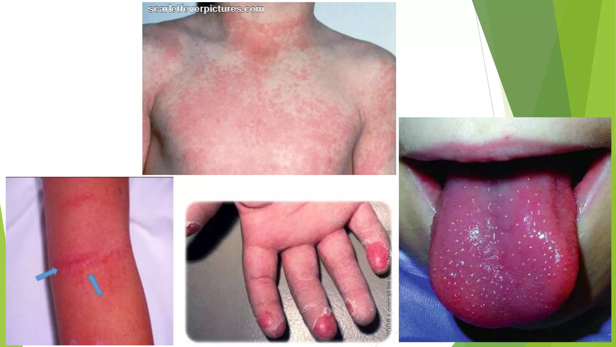 Fever and rash in pediatrics - Dr Ameen Alawadhi | PPTX