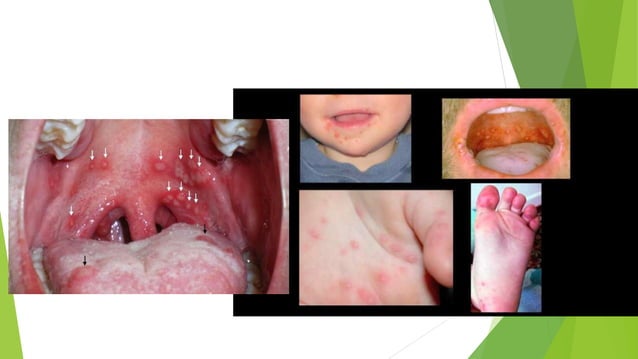 Fever and rash in pediatrics - Dr Ameen Alawadhi | PPTX