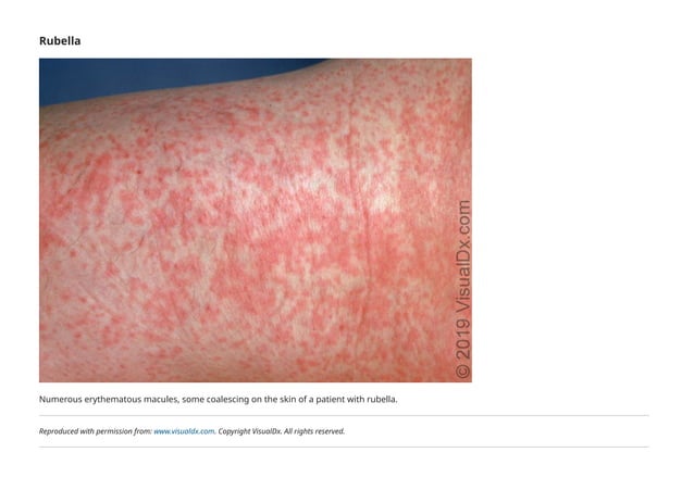 Fever and rash in the immunocompetent patient - UpToDate.pdf