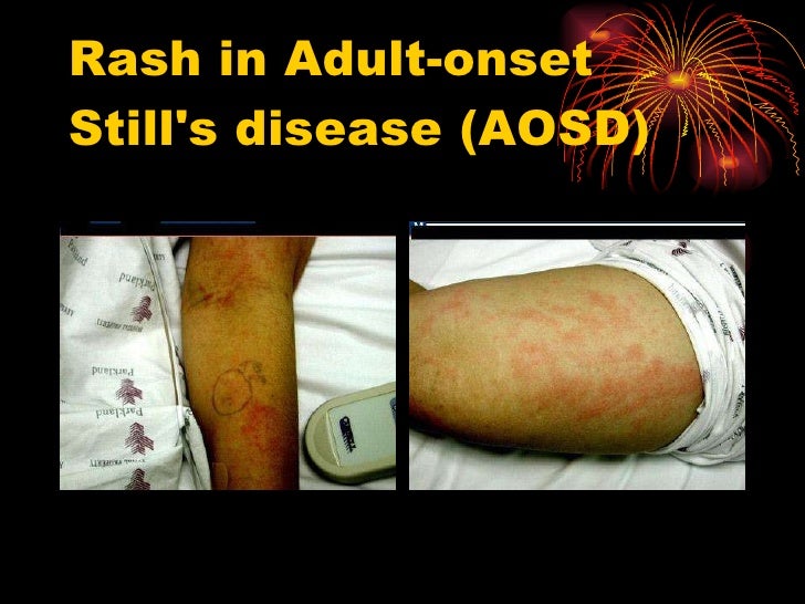 F E V E R A N D S K I N R A S H Final