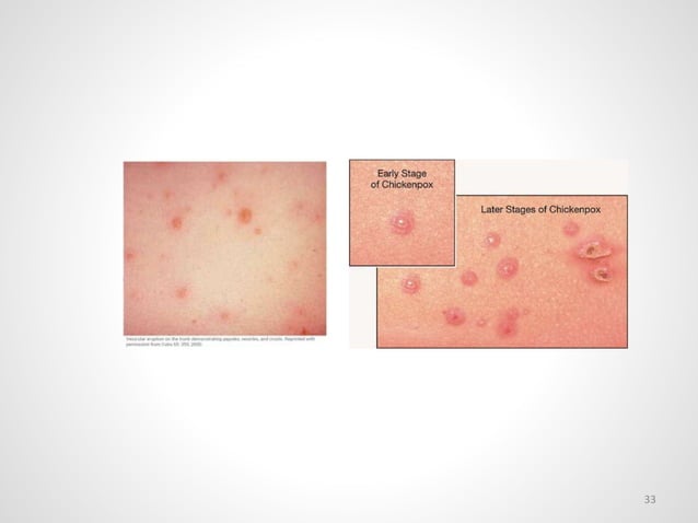 Fever and Rash | PPTX