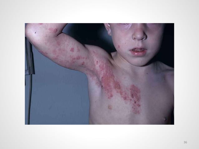 Fever and Rash | PPTX