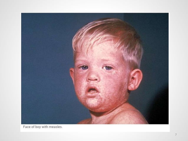 Fever and Rash | PPTX