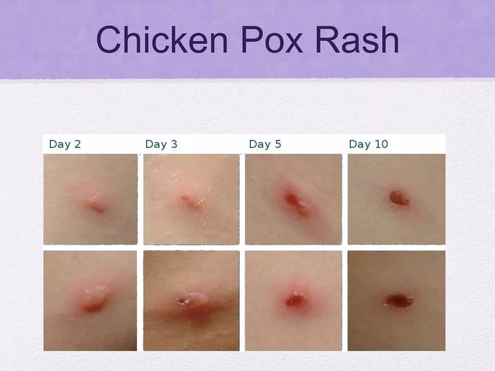 Demystifying Fever & Rash in Children | PPTX