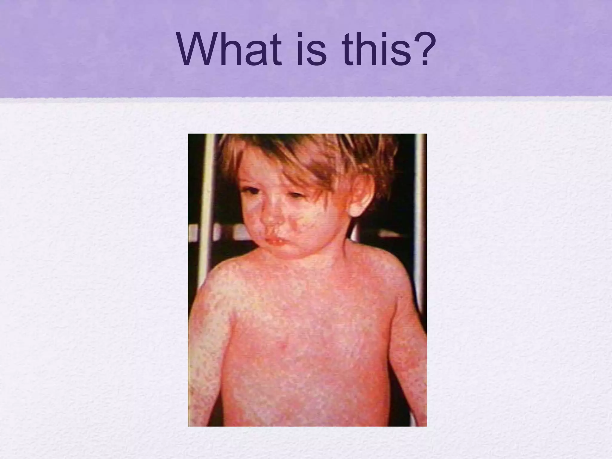 Demystifying Fever & Rash in Children | PPTX