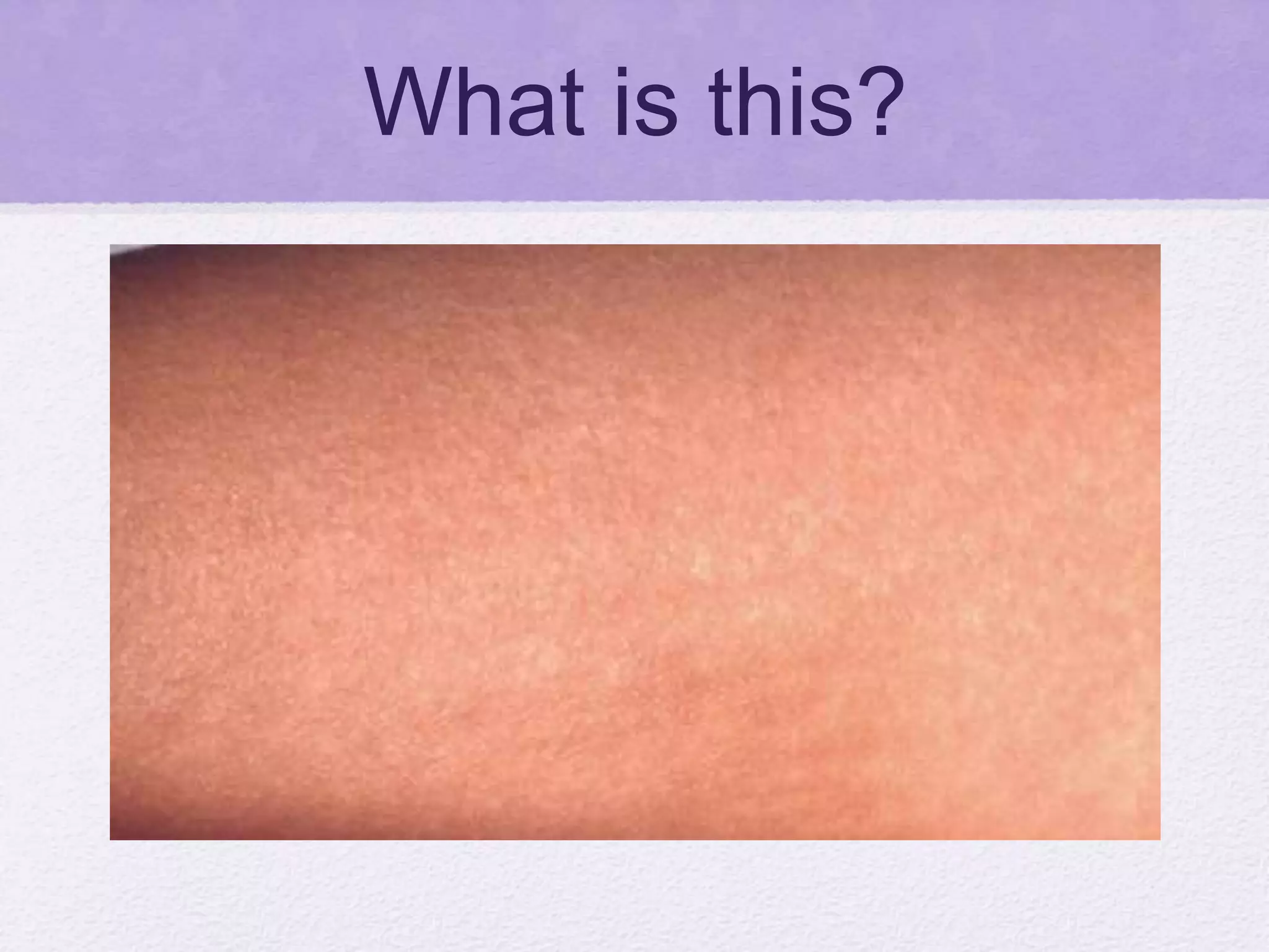 Demystifying Fever & Rash in Children | PPTX