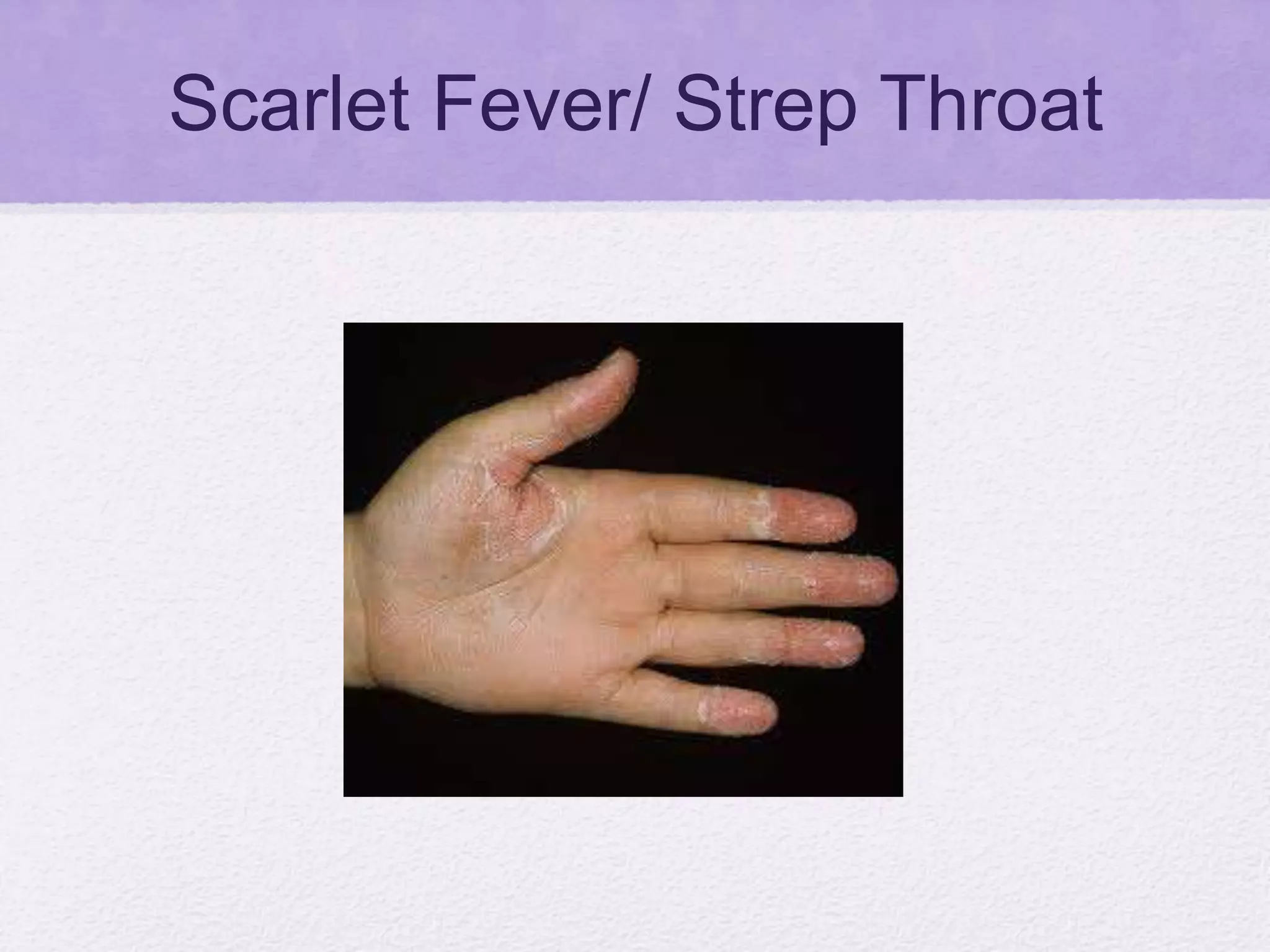 Demystifying Fever & Rash in Children | PPTX