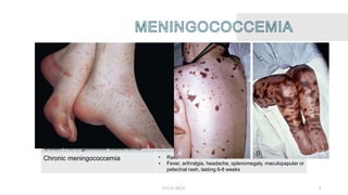 Pediatrics: FEVER and RASH (Nelson Textbook of Pediatrics 21st Edition ...