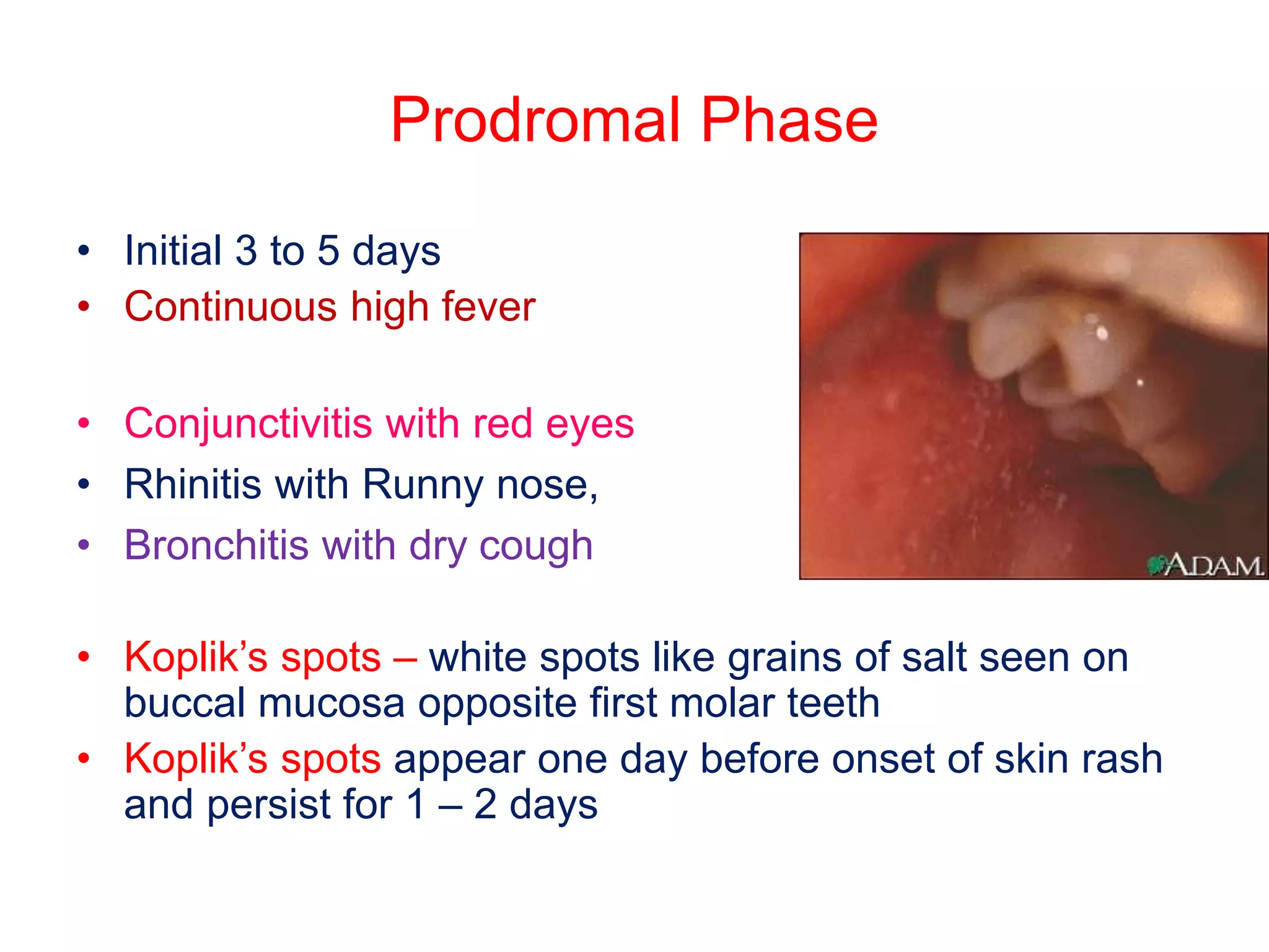 Fever with a maculopapular skin rash in children 2021 | PDF