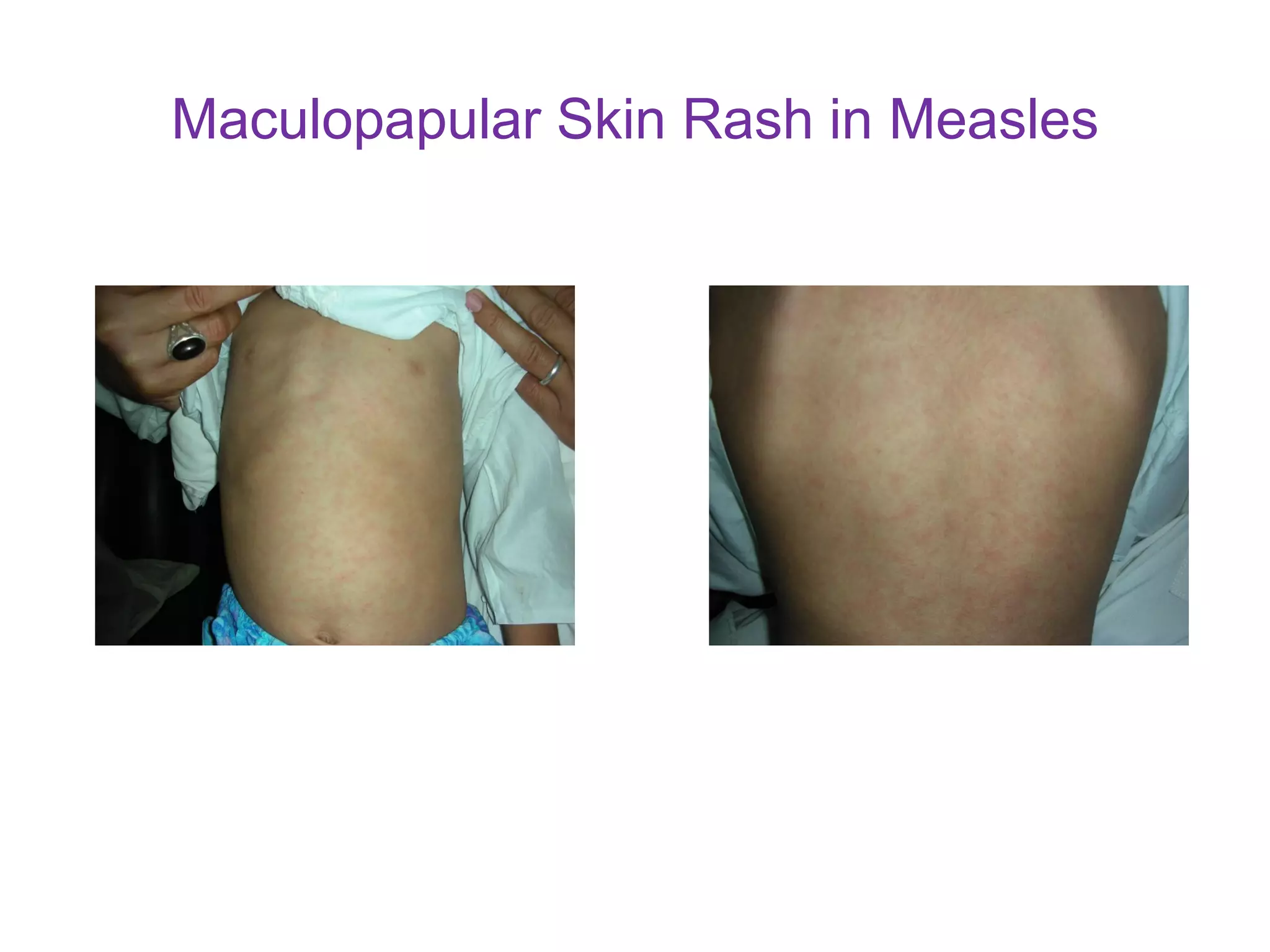 Fever with a maculopapular skin rash in children 2021 | PDF