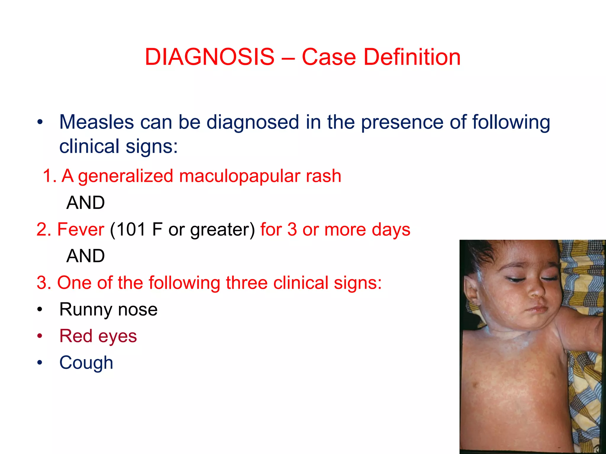 Fever with a maculopapular skin rash in children 2021 | PDF