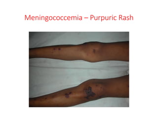 Fever with a purpuric skin rash in children 2021 | PDF