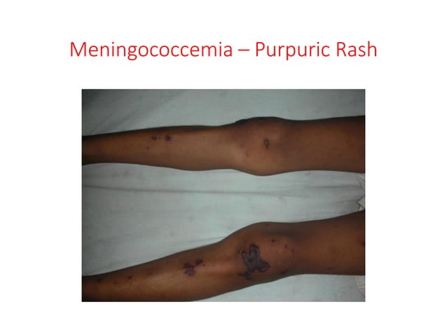 Fever with a purpuric skin rash in children 2021 | PPT