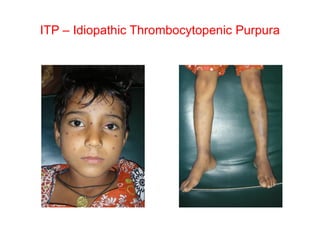 Fever with a purpuric skin rash in children 2021 | PDF