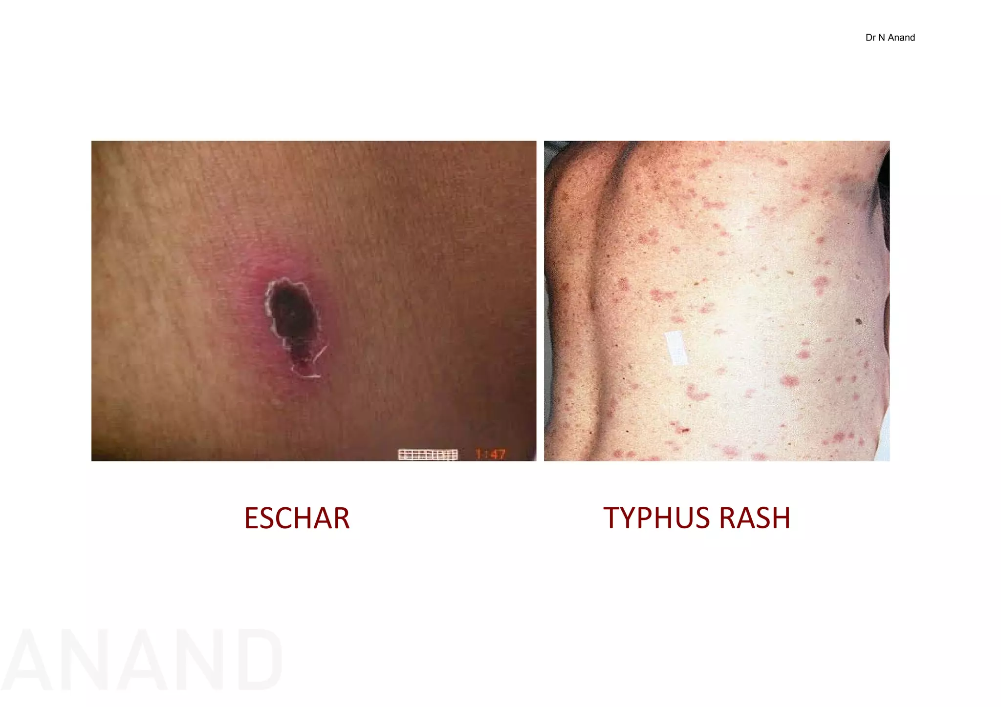 Fever with Rash | PDF