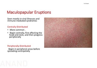 Maculopapular Rash