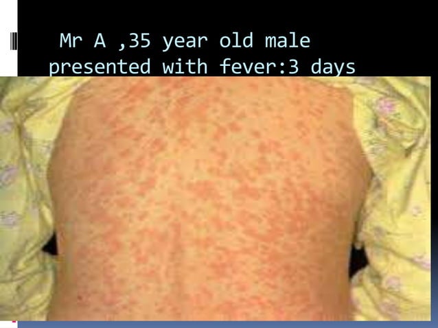Fever with rash | PPT