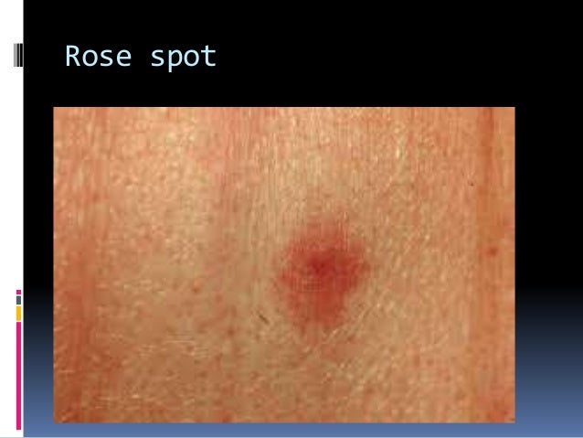 Fever With Rash fever-with-rash