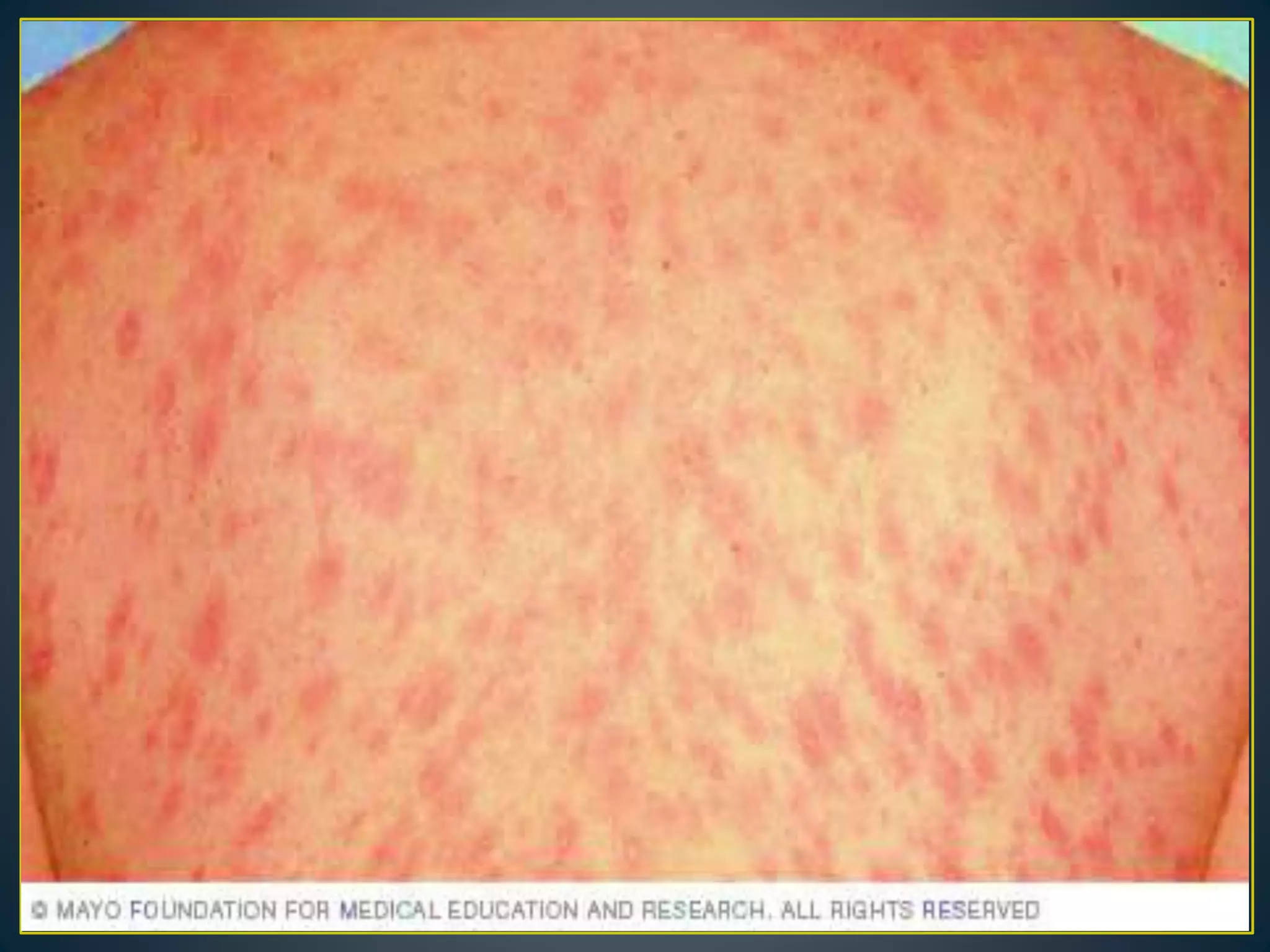 Fever with rash in dermatology. | PPTX