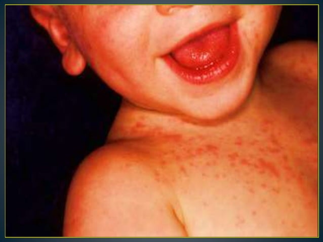 Fever with rash in dermatology. | PPTX | Infectious Diseases | Diseases ...
