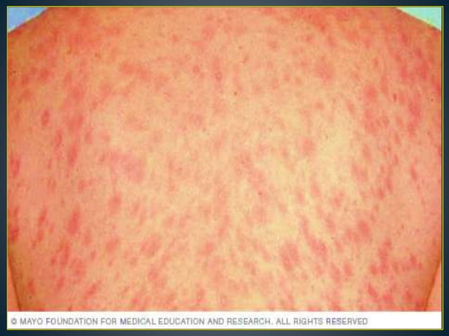 Fever with rash in dermatology. | PPTX | Infectious Diseases | Diseases ...