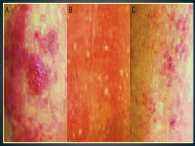Fever with rash in dermatology. | PPTX | Infectious Diseases | Diseases ...