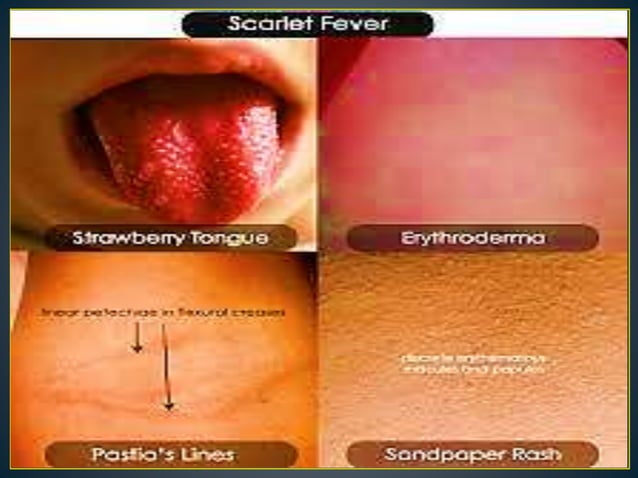 Fever with rash in dermatology. | PPTX | Infectious Diseases | Diseases ...