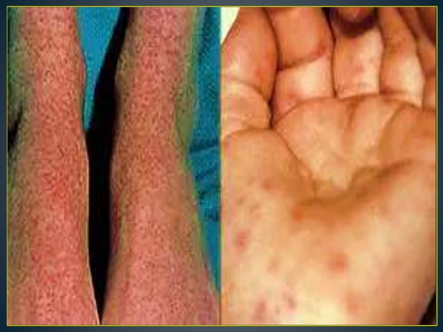 Fever with rash in dermatology. | PPTX | Infectious Diseases | Diseases ...