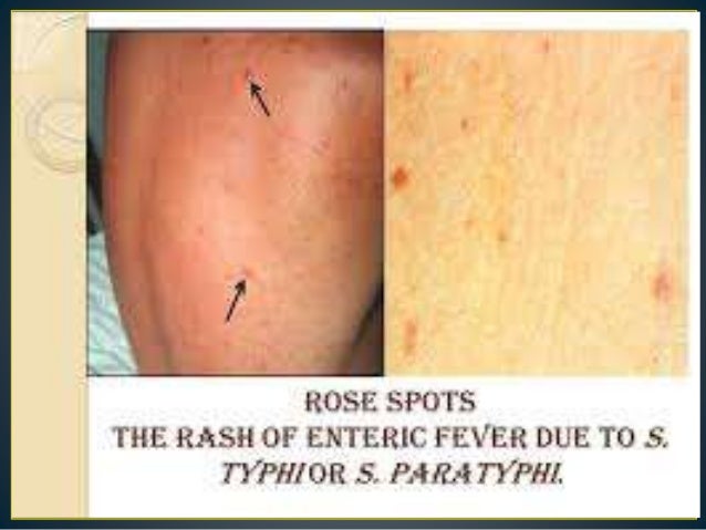 Fever with rash in dermatology.
