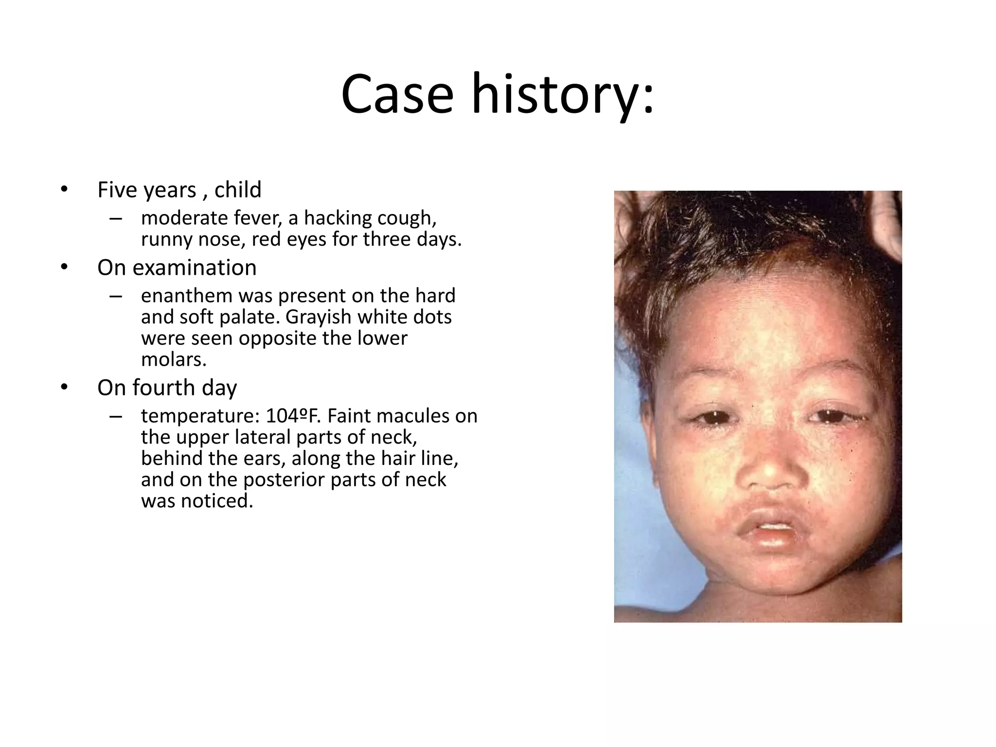 Fever with rash | PPT