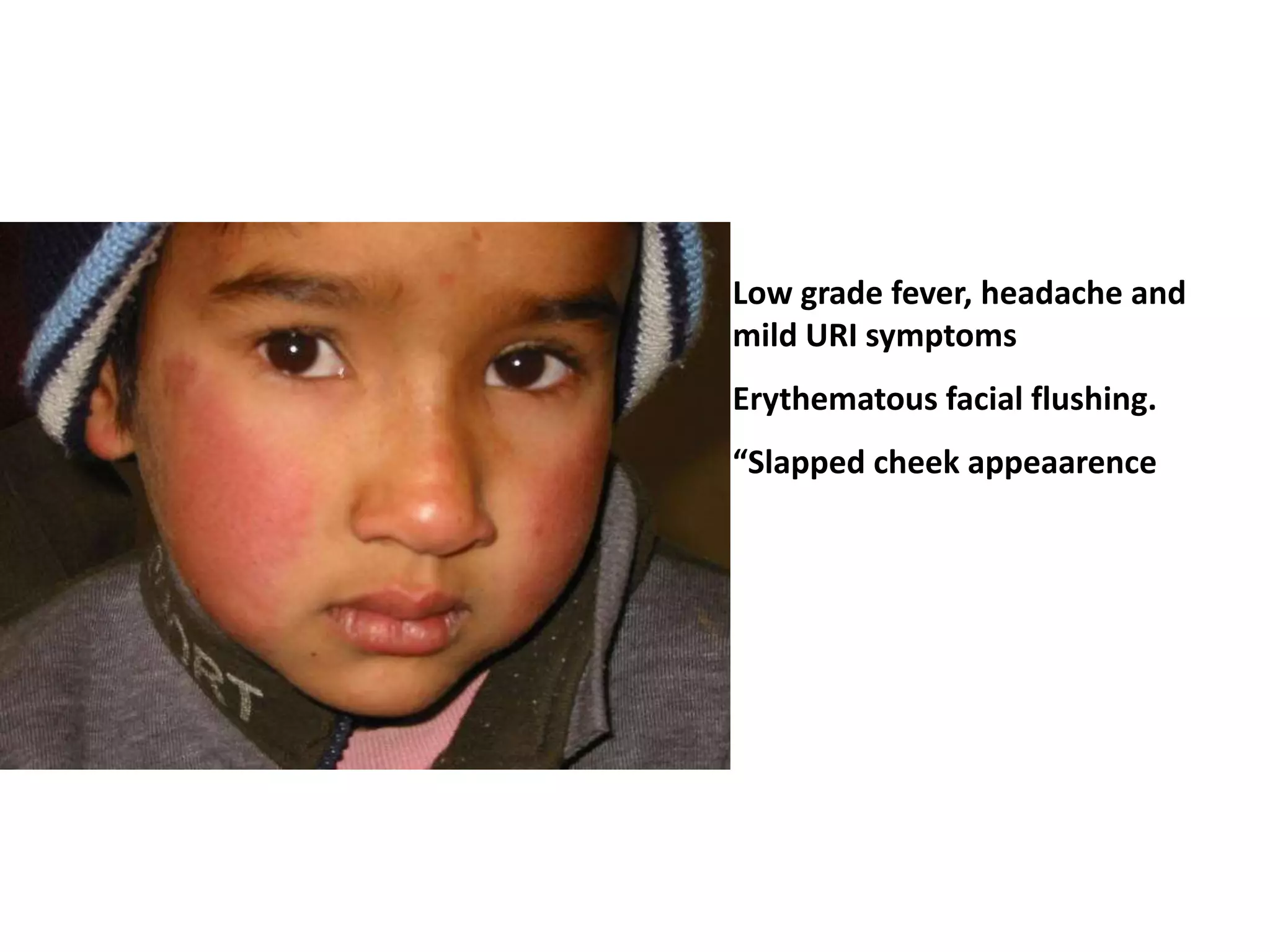 Fever with rash | PPT