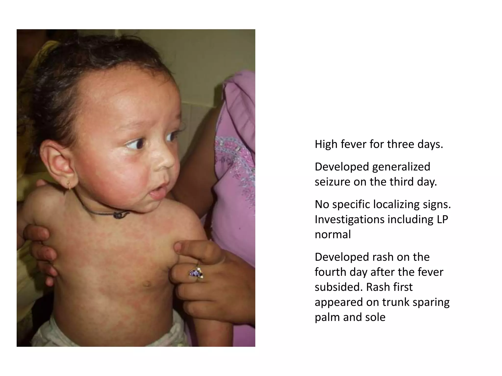 Fever with rash | PPT