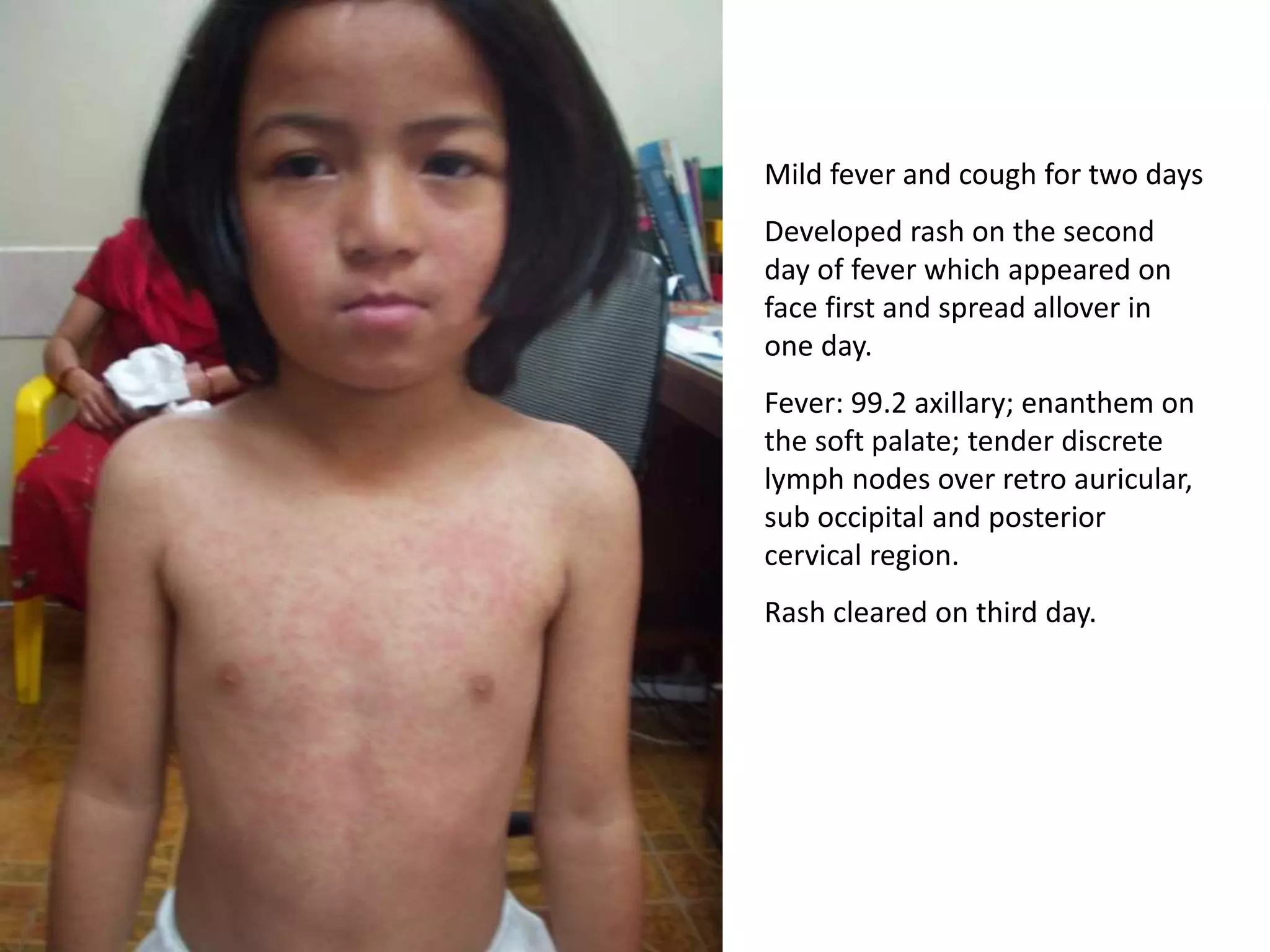 Fever with rash | PPT