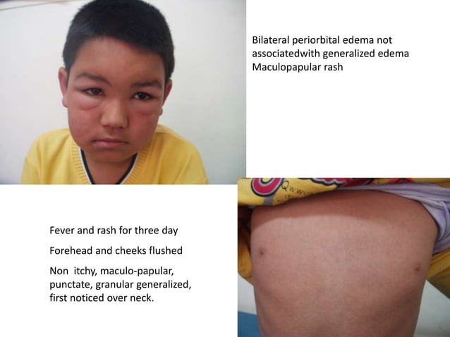 Fever with rash | PPT