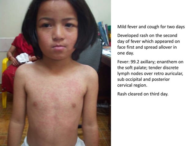 Fever with rash | PPT