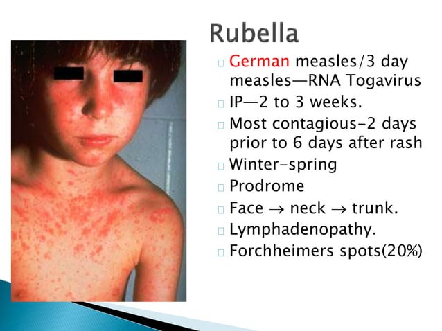 Fever with rashes | PPTX