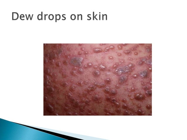 Fever with rashes | PPTX