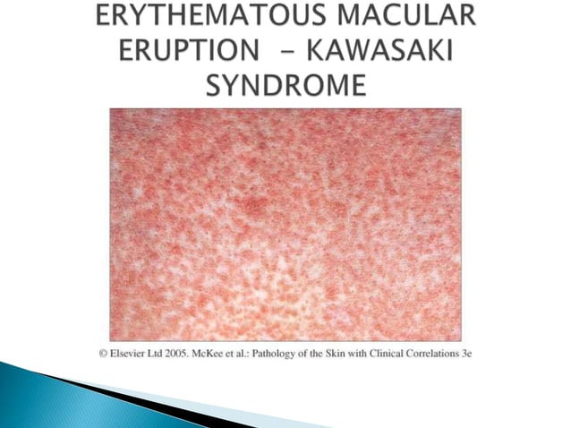 Fever with rashes | PPTX