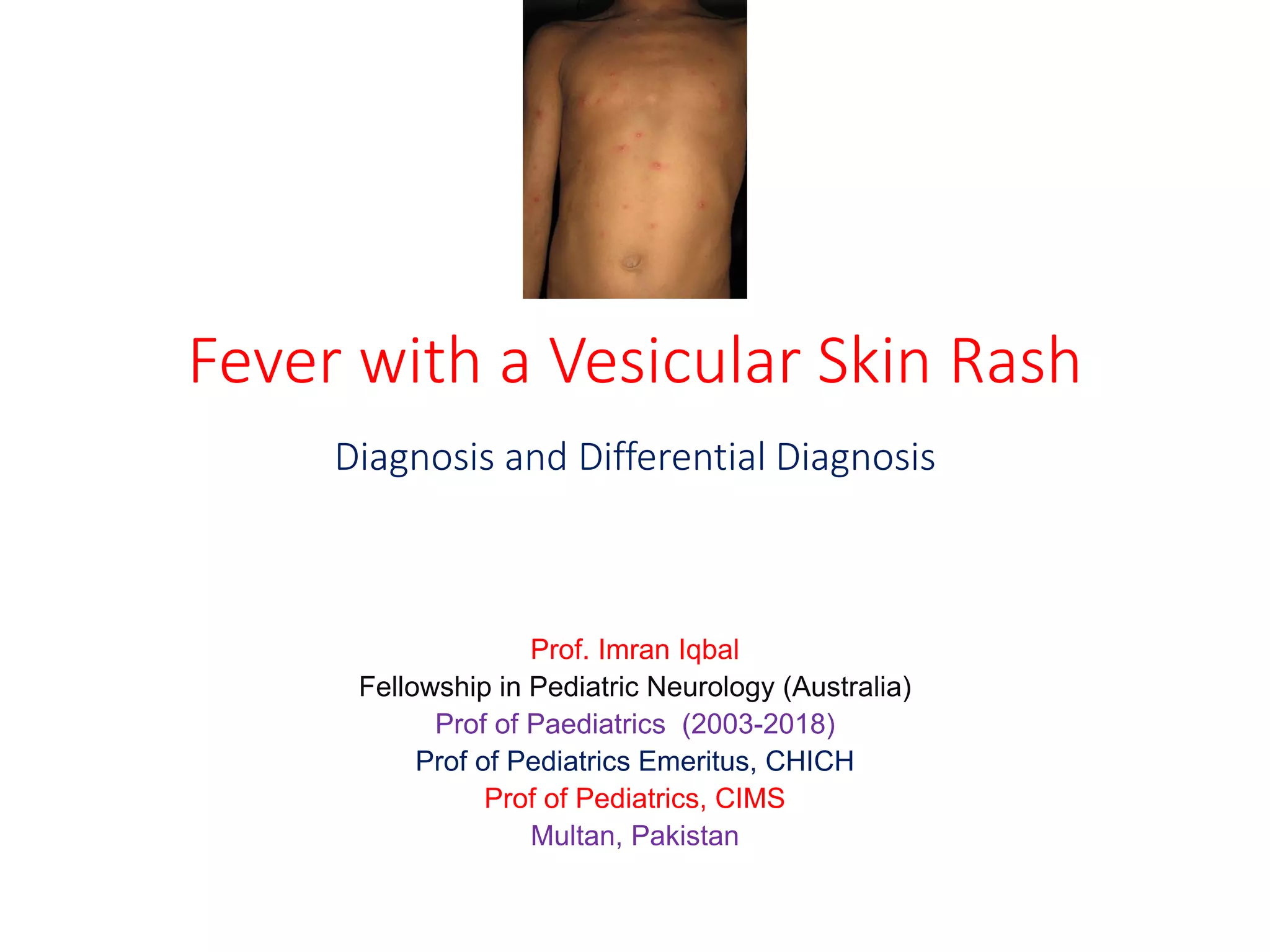 Fever with vesicular skin rash in children 2021 | PDF