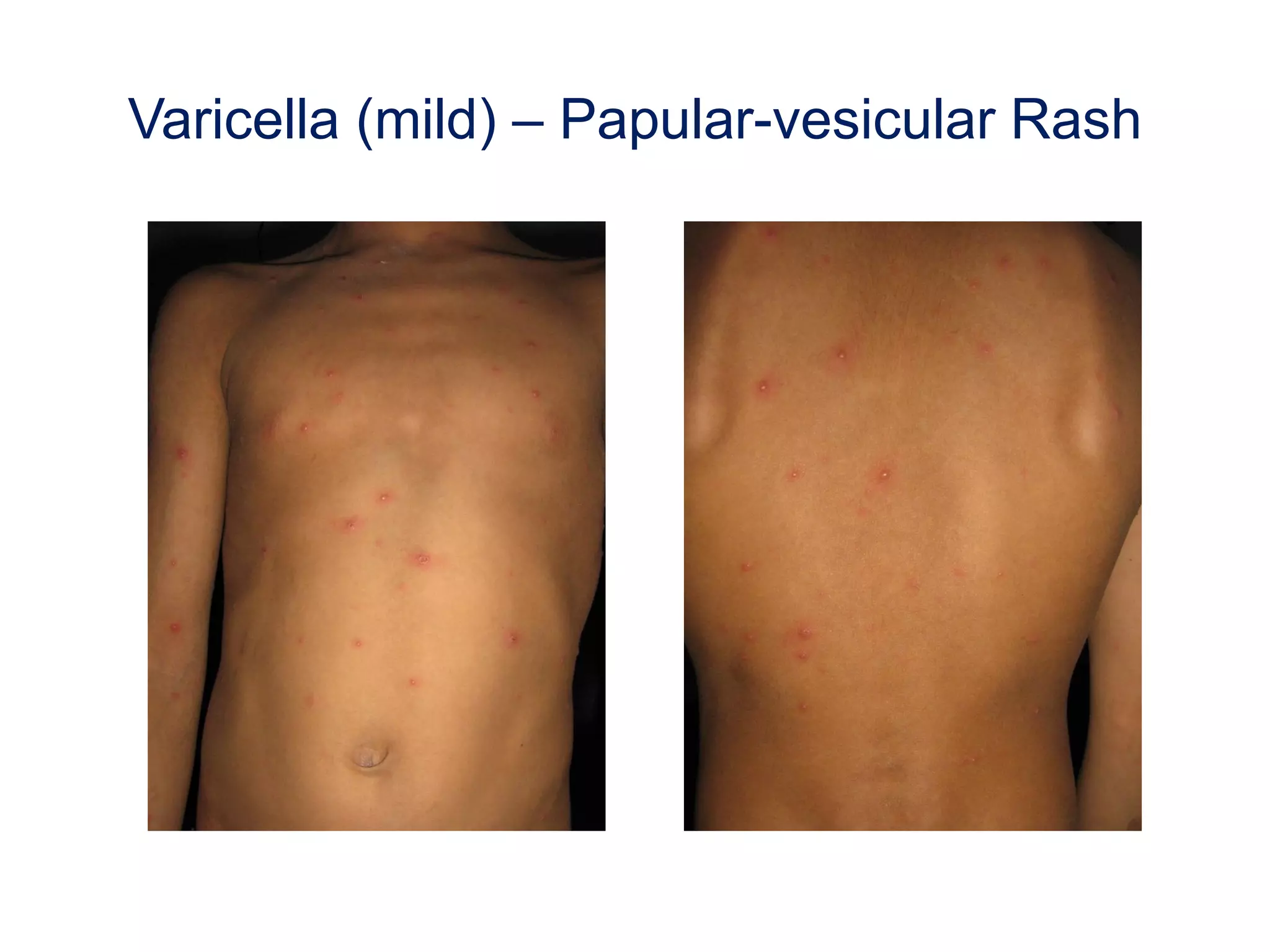 Fever with vesicular skin rash in children 2021 | PDF | Infectious ...