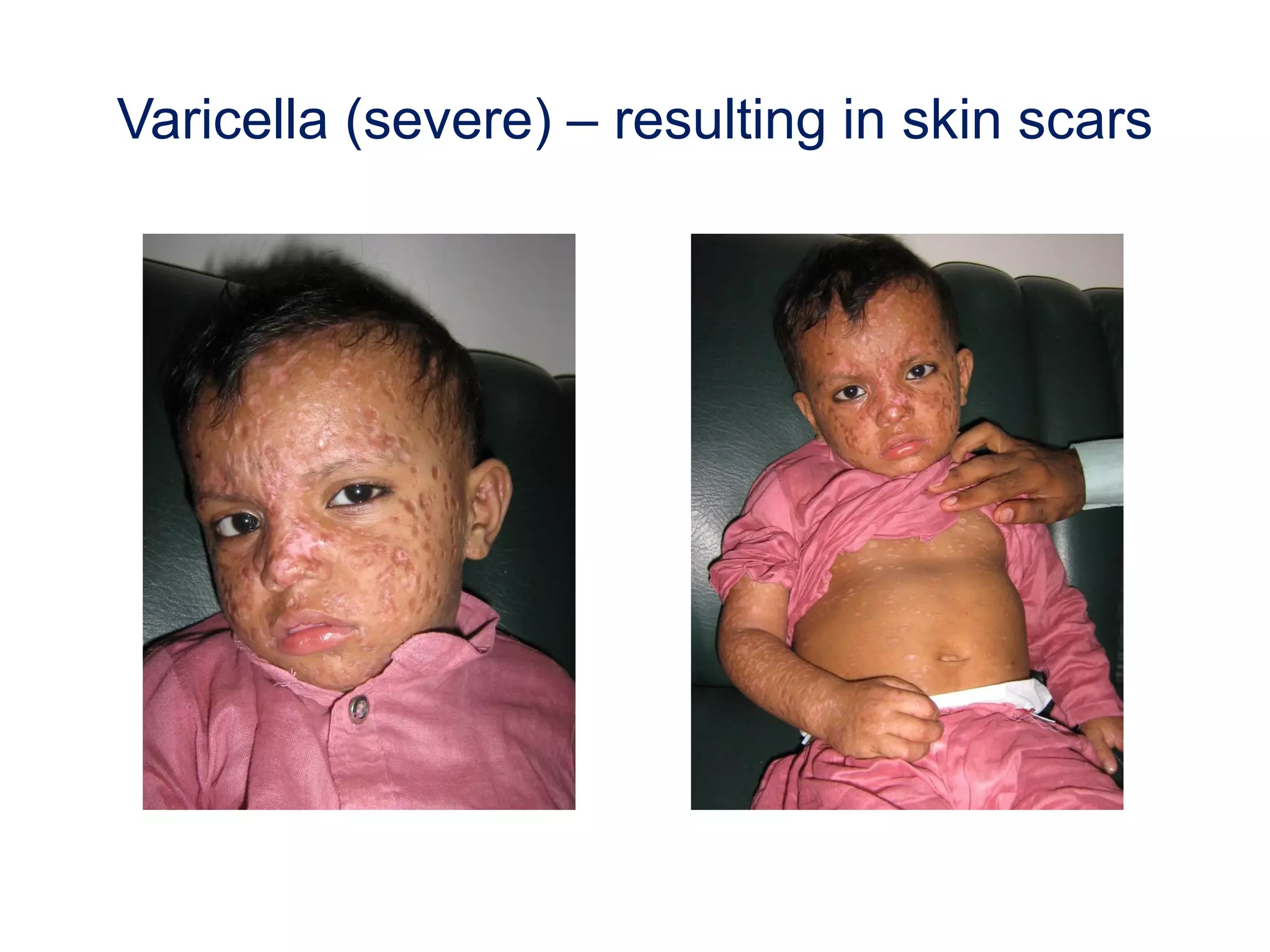 Fever with vesicular skin rash in children 2021 | PDF