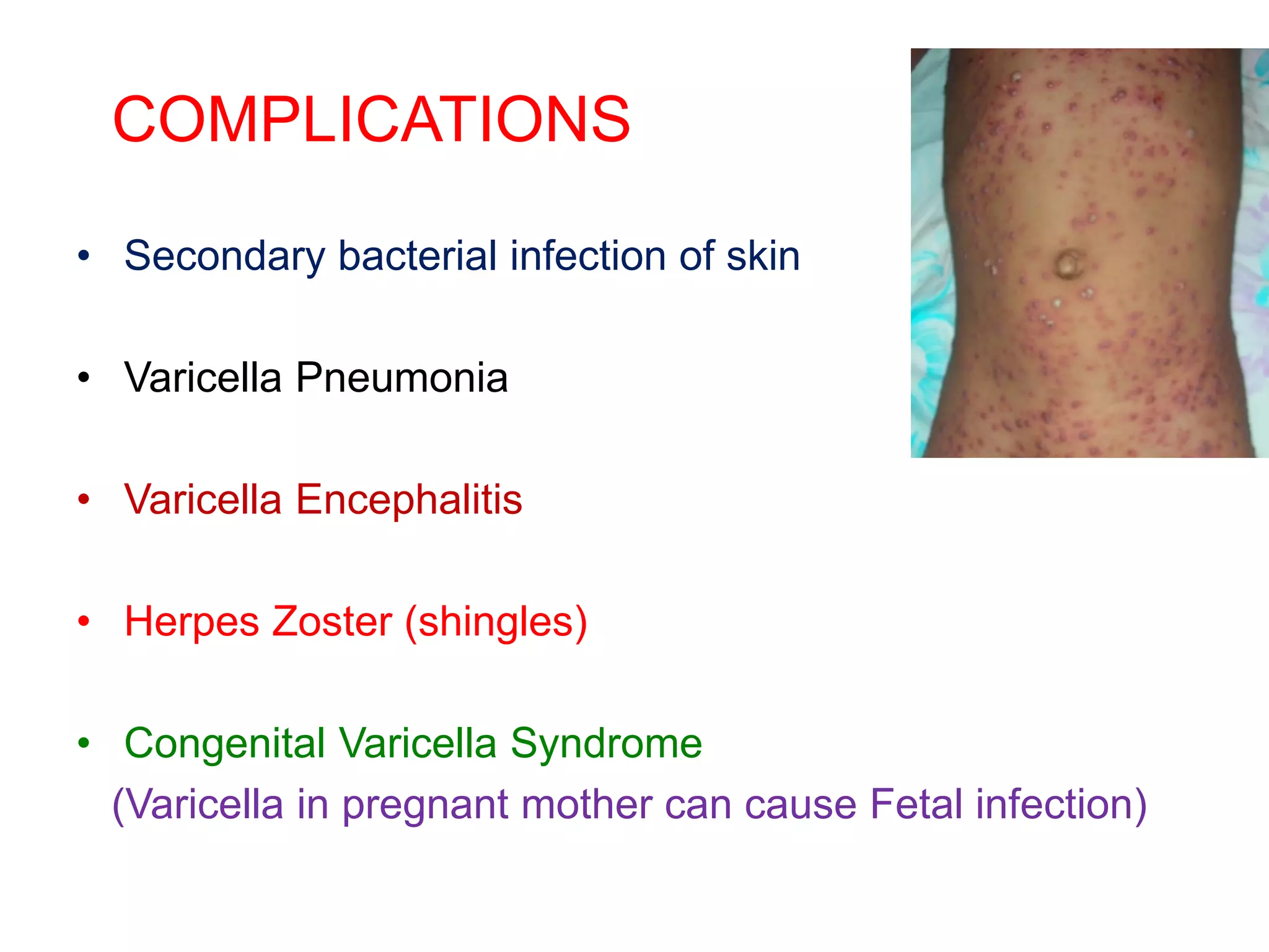 Fever with vesicular skin rash in children 2021 | PDF