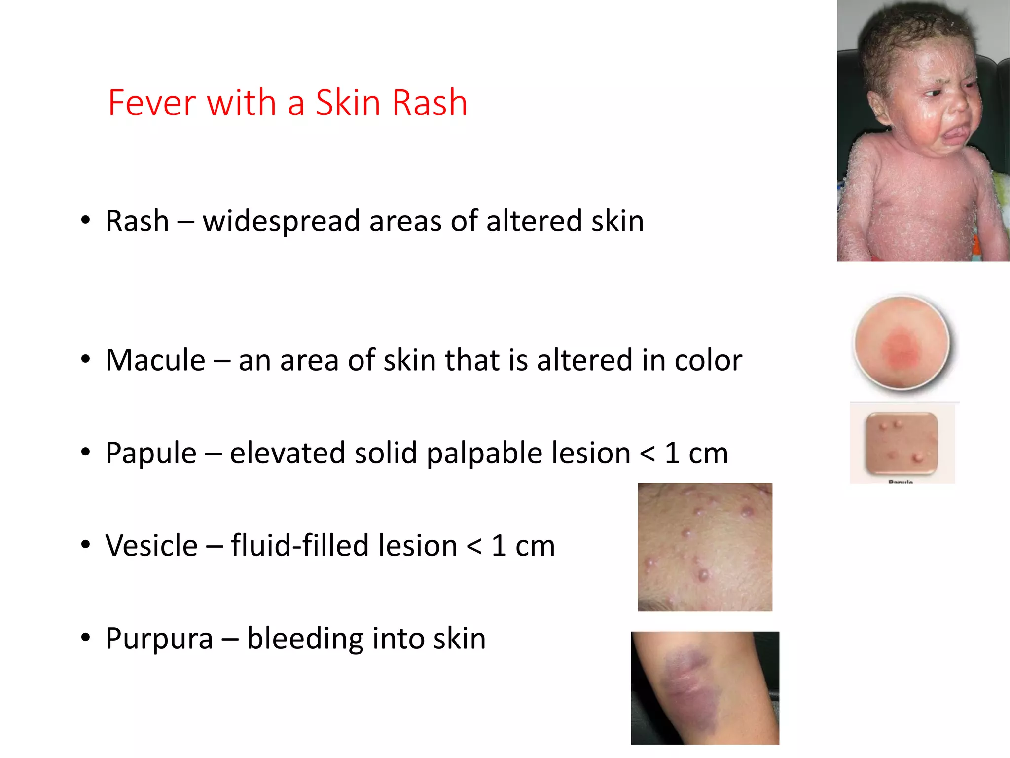 Fever with vesicular skin rash in children 2021 | PDF