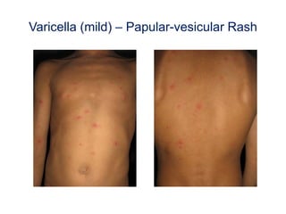 Fever with vesicular skin rash in children 2021 | PDF