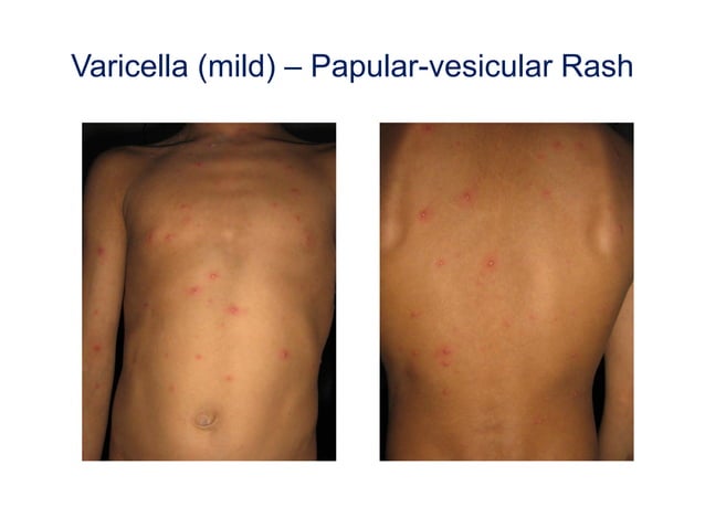 Fever with vesicular skin rash in children 2021 | PDF | Infectious ...