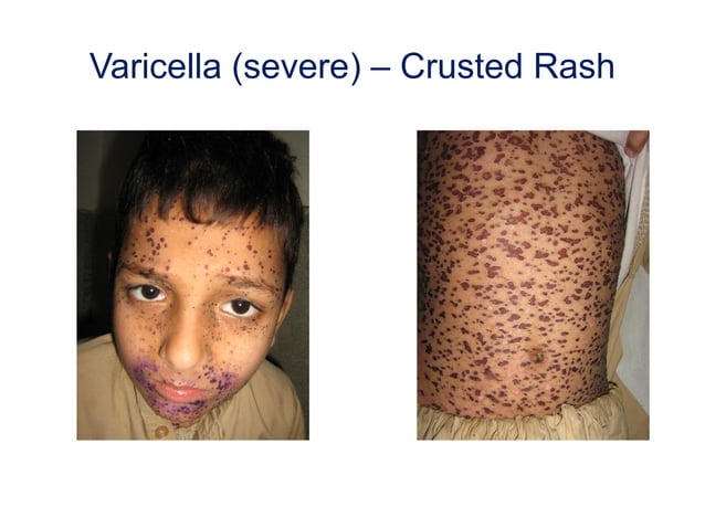 Fever with vesicular skin rash in children 2021 | PDF | Infectious ...