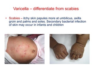 Fever with vesicular skin rash in children 2021 | PDF
