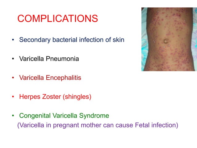 Fever with vesicular skin rash in children 2021 | PDF | Infectious ...
